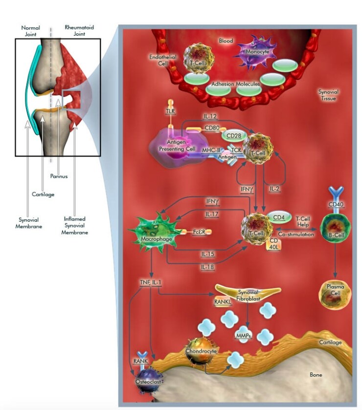 Pathogenesis of Rheumatoid Arthritis | Thermo Fisher Scientific - US Pathogenesis of Rheumatoid Arthritis | Thermo Fisher Scientific - US